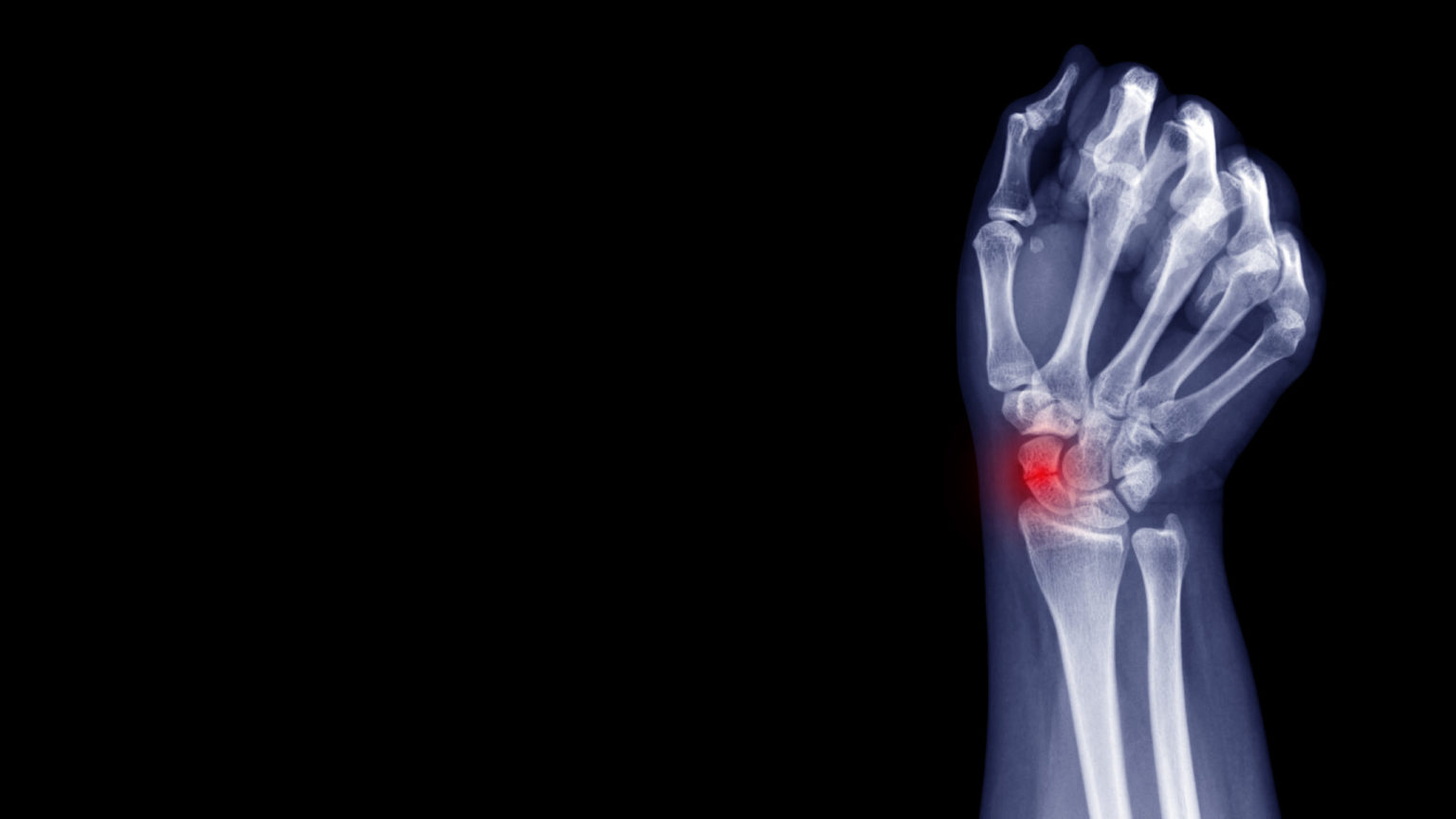 Scaphoid fractures - Avanthi Mandaleson