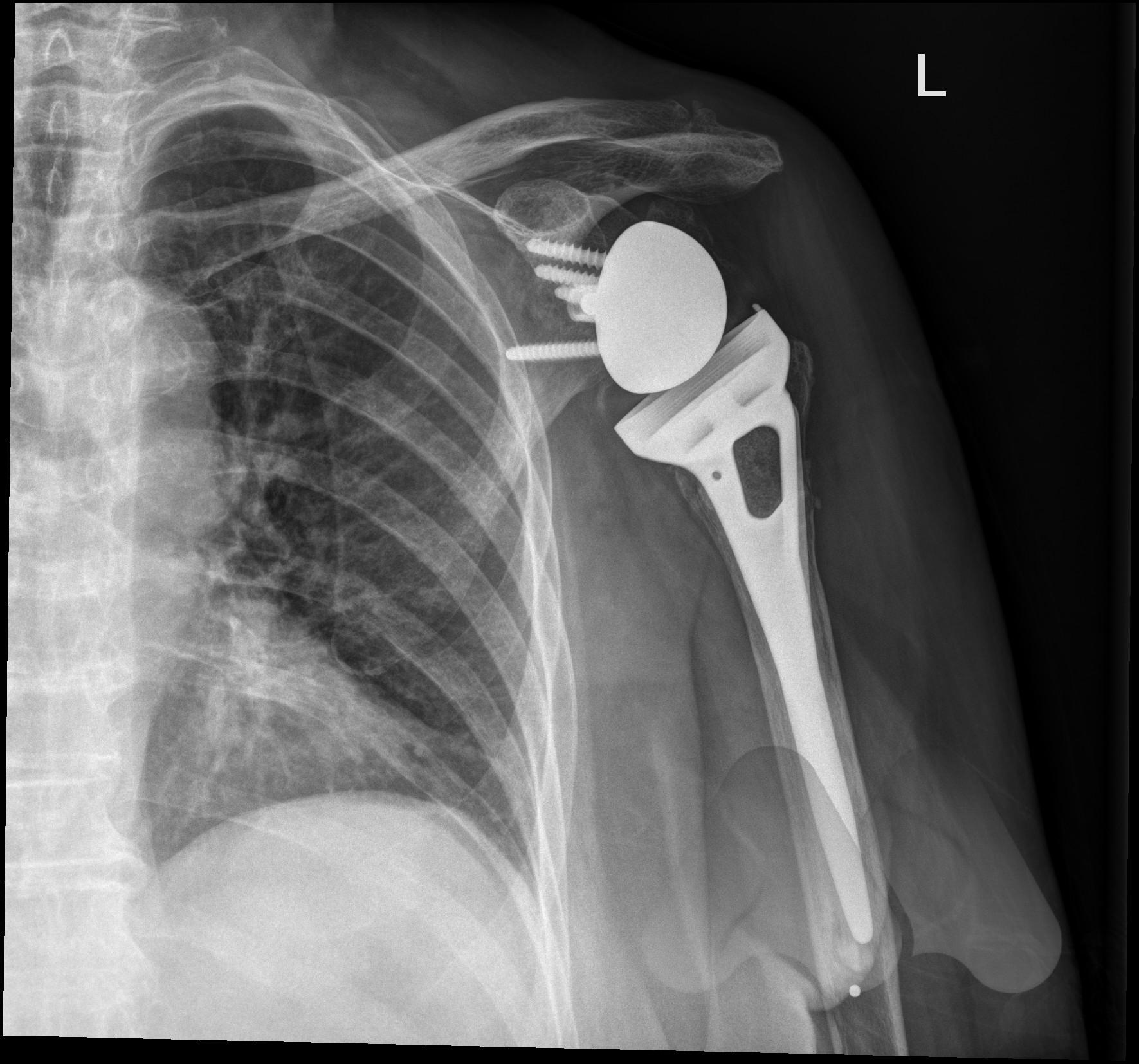 Shoulder Arthritis Avanthi Mandaleson Shoulder Arthritis Avanthi Mandaleson