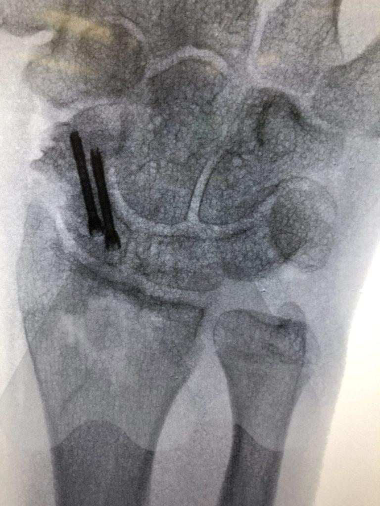 Scaphoid fractures - Avanthi Mandaleson