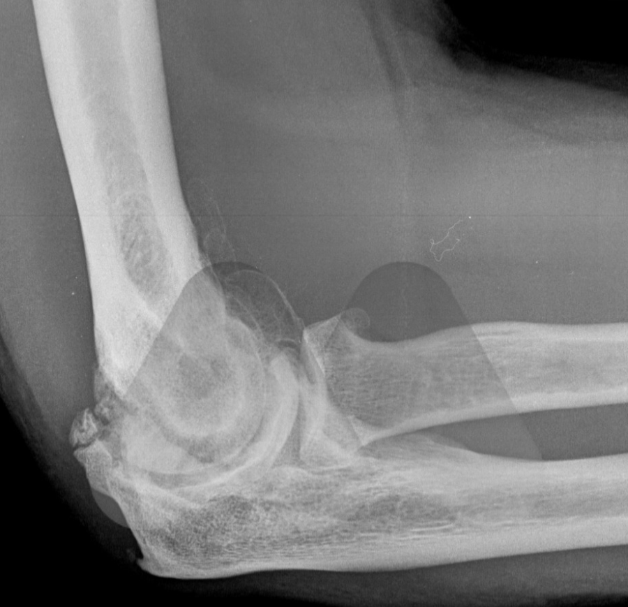 Stiff Elbow and osteoarthritis - Avanthi Mandaleson