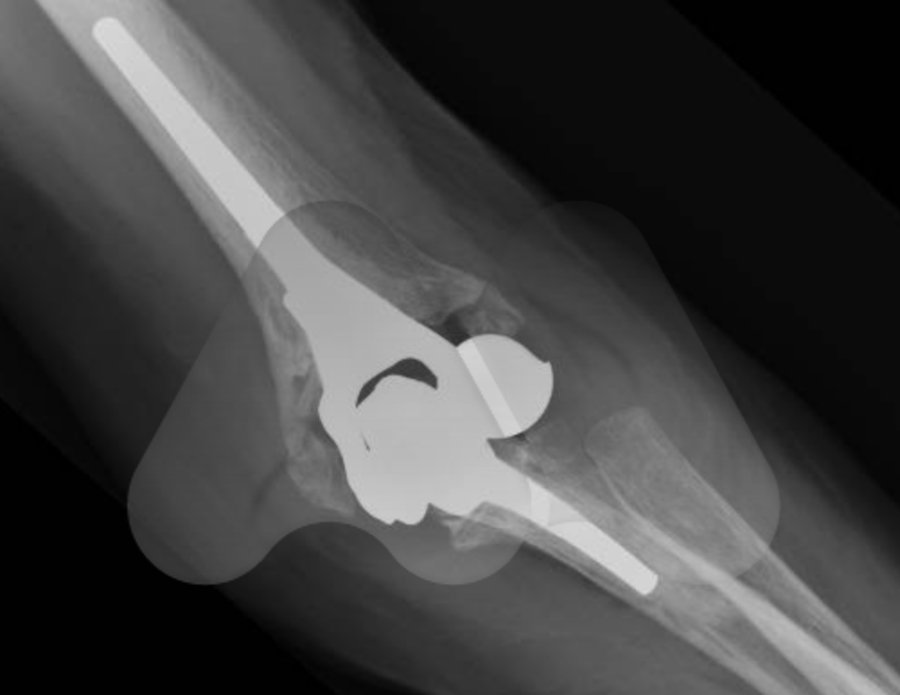 Stiff Elbow and osteoarthritis - Avanthi Mandaleson