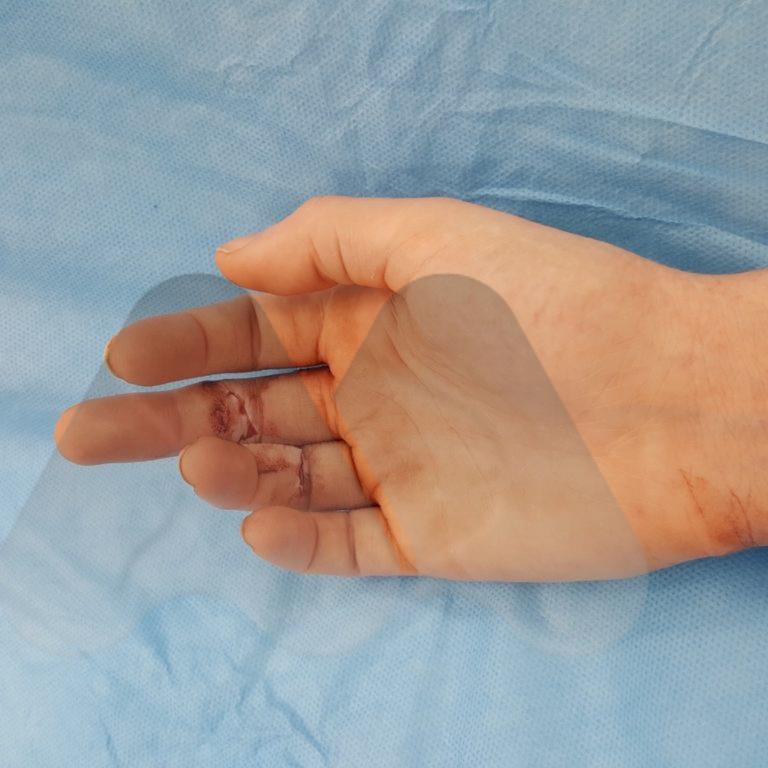 Dr Avanthi Mandaleson - Specialist Hand & Upper Limb Surgeon